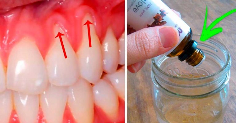 10 Easy Ways to Heal Receding Gums Naturally