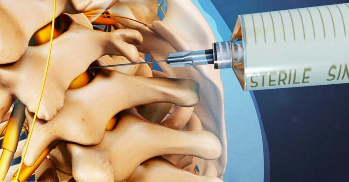 FDA Warns About Dangers of Epidural Steroid Injections for Back Pain
