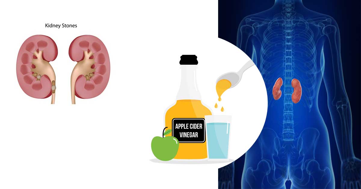 4 Ways to Help Dissolve Kidney Stones Naturally Using Apple Cider Vinegar